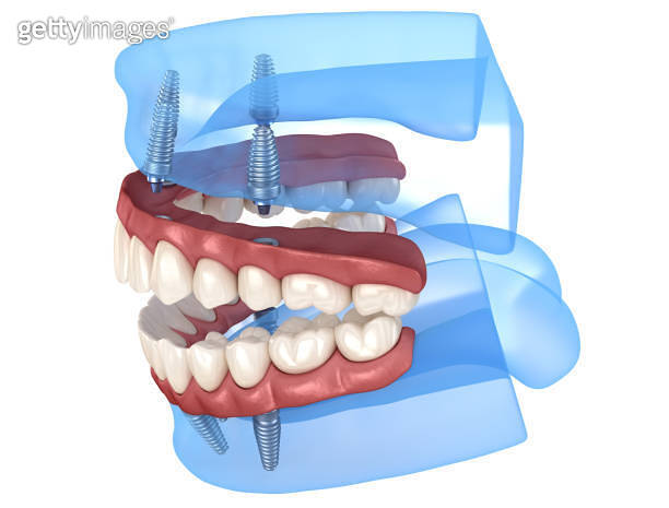 Maxillary and Mandibular prosthesis with gum All on 4 system supported ...