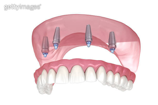 Maxillary prosthesis with gum All on 4 system supported by implants ...