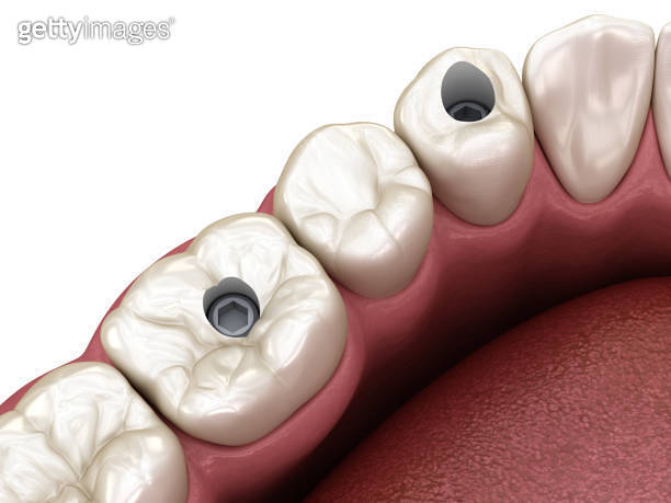 Premolar and Molar tooth crown installation over implant, screw ...