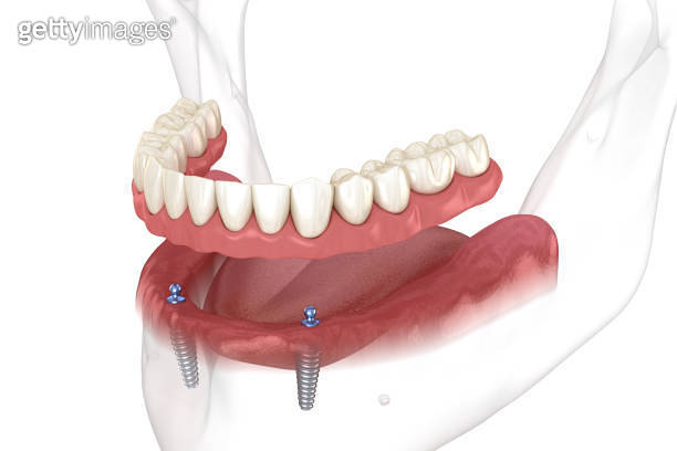 Mandibular removable prosthesis All on 2 system supported by implants ...