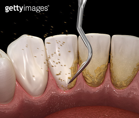 Oral hygiene: Ultrasonic teeth cleaning machine removing calculus and ...