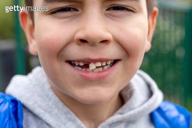 The baby boy smiling with wobbly milk tooth in open mouth. First molar ...