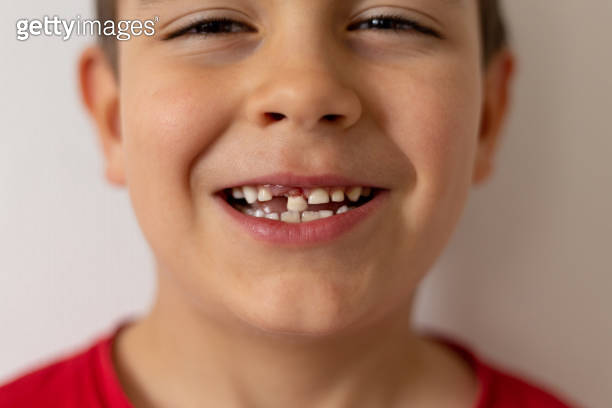 The baby boy smiling with wobbly milk tooth in open mouth. First molar ...