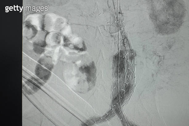 x-ray image. Angiogram of right common iliac artery after aortic stent ...