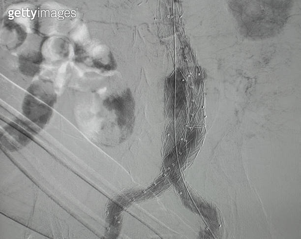 x-ray image. Angiogram of right common iliac artery after aortic stent ...