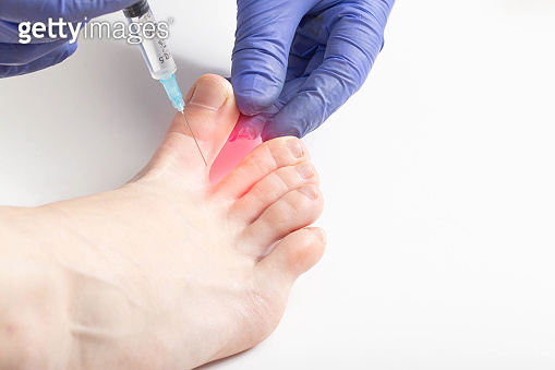 The doctor makes an injection between the toes against hyperhidrosis ...