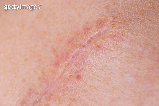 Scar on the back of a woman after the stitches have been removed ...