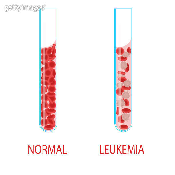Lekemia. Tubes with normal and leukemic blood cells. Isolated vector ...