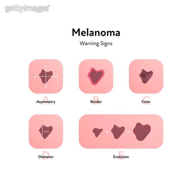 Melanoma cancer anatomical infographic poster. Vector flat medical ...