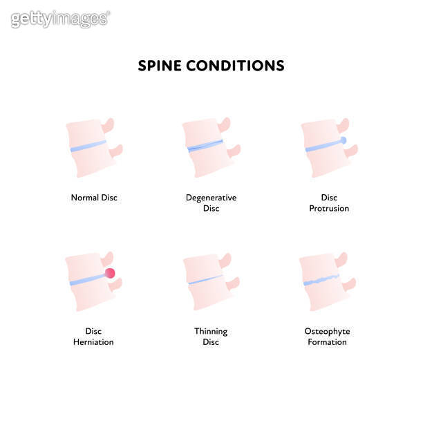 Spine disk condition. Vector flat anatomical illustration. Icon set ...