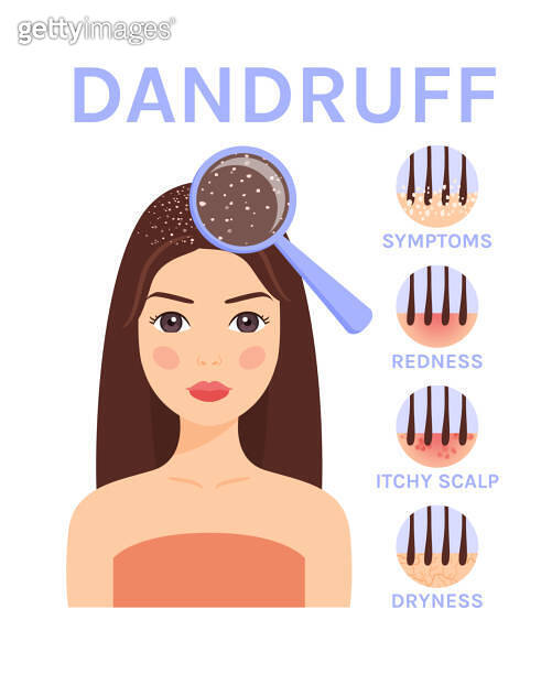 Dandruff and Magnifying Glass on the Head of pretty Woman.Disease and ...