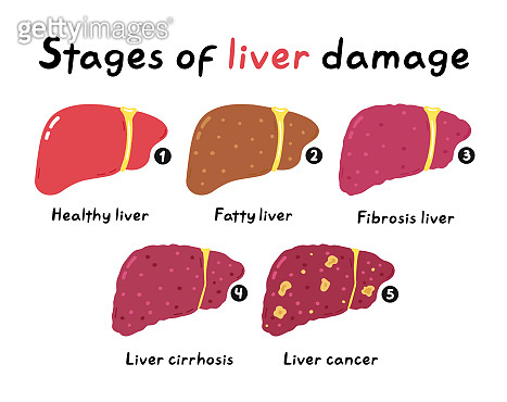 Stages of liver damage infographic. Vector hand drawn cartoon ...