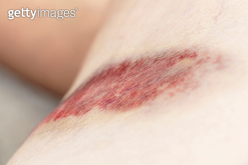 The bruises and wound form scabs on legs. The wound happen during woman ...