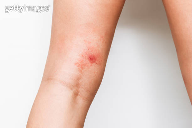 A red rash on the female thigh caused by an insect bite, allergy or an ...