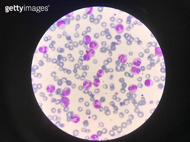 Immature and mature white blood cells.Segmented neutrophil,blast cells ...