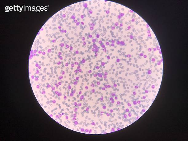 Immature and mature white blood cells.Segmented neutrophil,blast cells ...