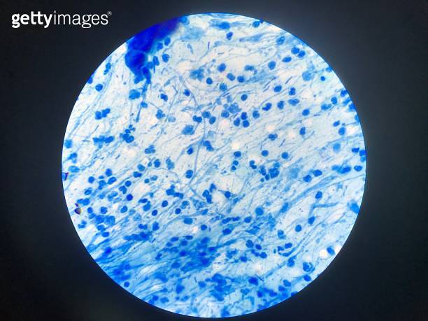 Smear sputum acid fast bacilli stain negative non Tuberculosis. 이미지 ...