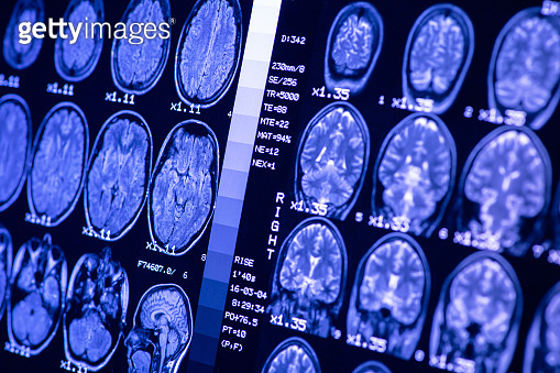 MRI of brain of a healthy person with blue illumination. Magnetic ...