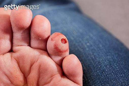 Laser removal of wart from the toe of foot. Cut out verruca ...