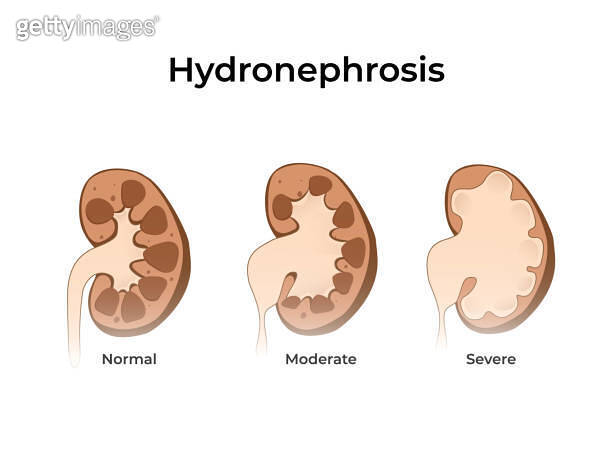 Normal kidney with hydronephrosis. Vector illustration of the of the ...