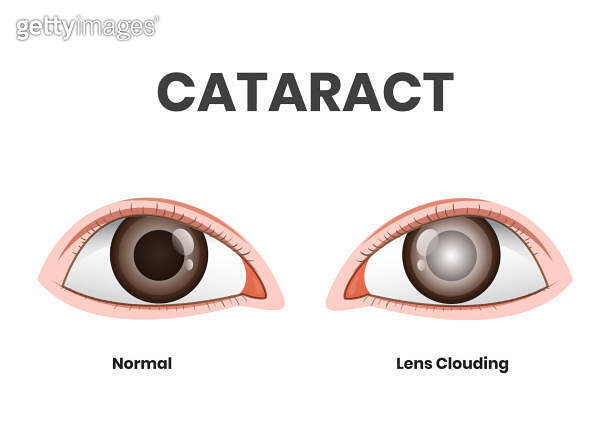 Cataract vector illustration. Healthy eye versus lens clouding ...