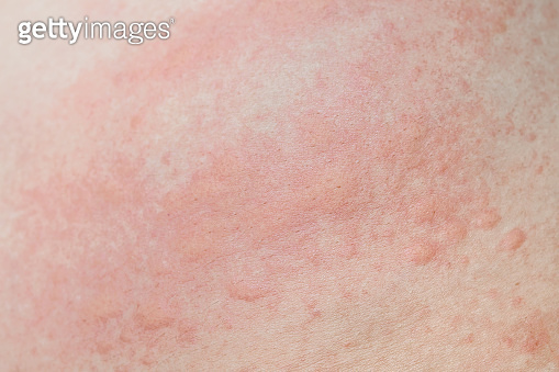 Allergic skin rash prickly heat skin red dot closeup skin problem ...