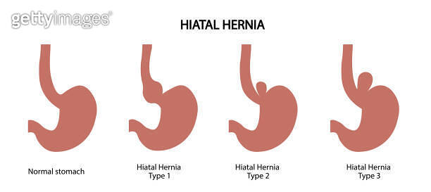 Hiatus hernia. Hiatal hernia. Types of hiatal hernia illustration 이미지 ...