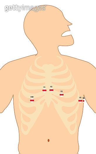 ECG (Electrocardiography) V4R ECG lead placement 이미지 (1317865197) - 게티이미지뱅크