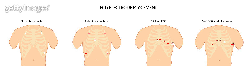 ECG (Electrocardiography) electrode placement. Differents methods to ...