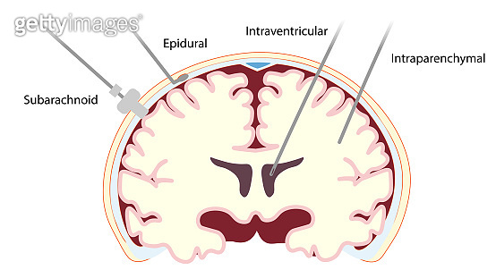Intracranial Pressure Monitoring (ICP) monitoring device placement in a ...