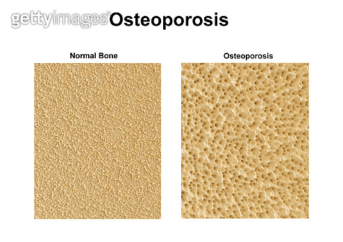 Normal bone structure density and with osteoporosis (1297407138) 일러스트 ...