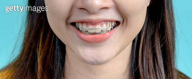 Close up Smiling Asian woman wearing orthodontic retainer on blue ...