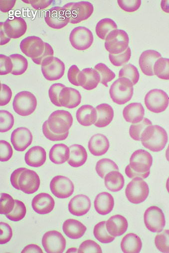 Target cells with abnormal red blood cells in blood smear (1324225693 ...