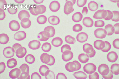 Target cells with abnormal red blood cells in blood smear (1324901152 ...