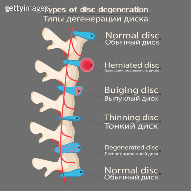 spinal disc degeneration illustration, educational medical illustration ...