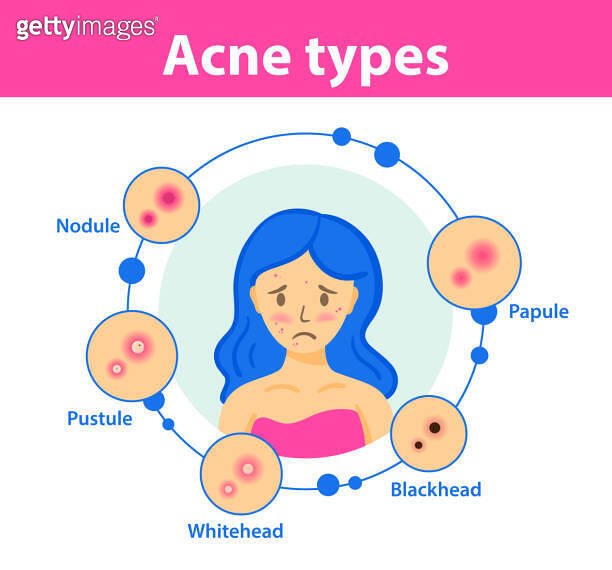Types of acne, causes of the disease, treatment. Infographics of acne ...