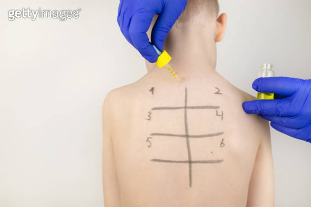 An allergist in the laboratory conducts an allergy prick-test. Skin ...