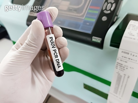 Blood sample for PUUV PCR DNA test. Medical test tube in laboratory ...
