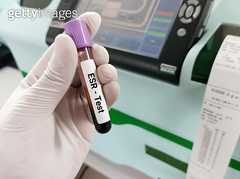 Blood sample for erythrocyte sedimentation rate (ESR) test. Medical ...