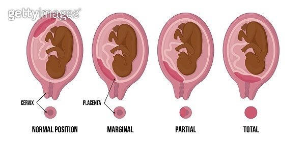 Different Placental Locations During African afroamerican Pregnancy ...