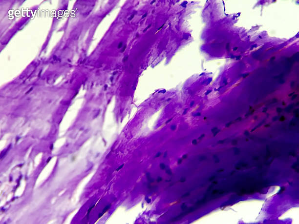 Lobular Capillary hemangioma, light micrograph, photo under microscope ...
