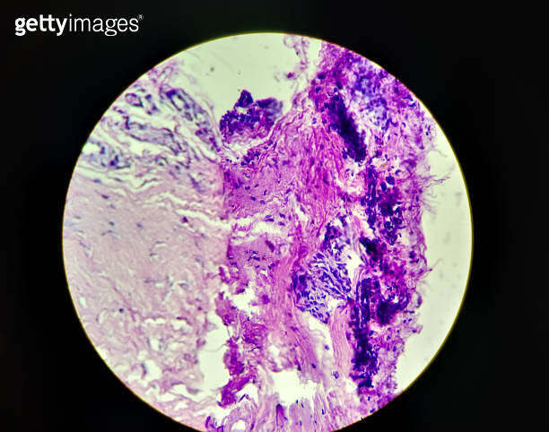 Lobular Capillary hemangioma, light micrograph, photo under microscope ...