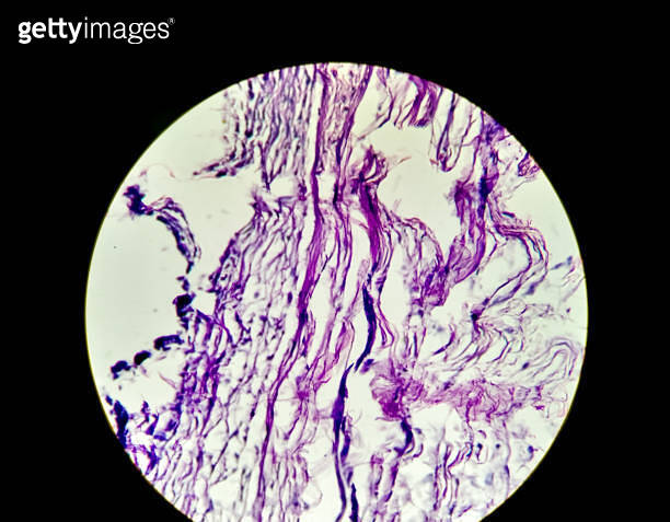 Lobular Capillary hemangioma, light micrograph, photo under microscope ...