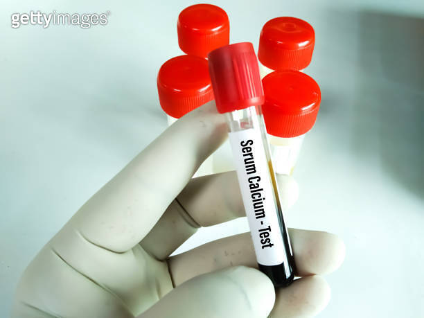 Blood sample tube for Serum Calcium test at medical laboratory ...