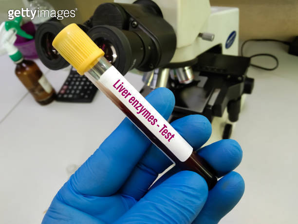 Blood sample tube for Liver enzymes test. (1340493702) - 게티이미지뱅크