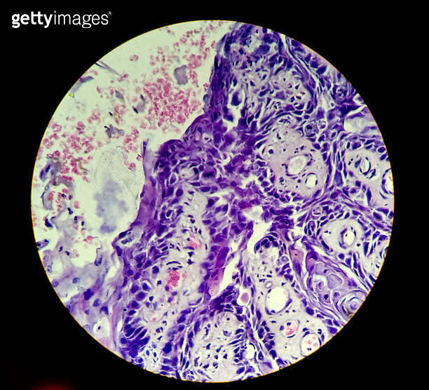 Acute appendicitis of human body with inflammed appendix and light ...