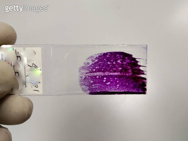 Histopathologist show a Microscopic glass eosin stained slide FNAC ...
