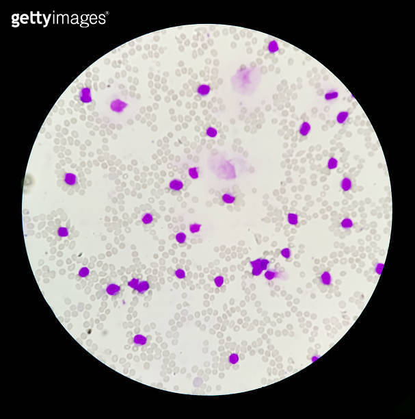 Blood smear Microscopic image of Acute mylohyoid leukemia (AML). 이미지 ...