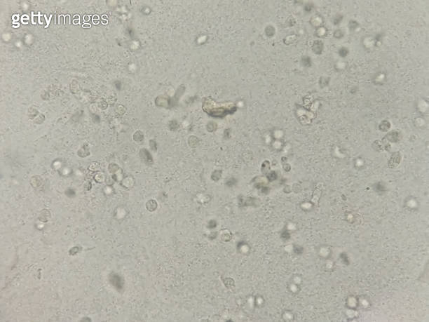 Urine microscopic examination 40x show plenty of pus cells and few ...