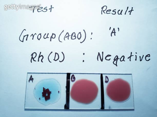 Blood group and Rh factor testing by slide agglutination method. Blood ...